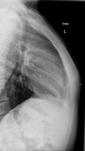 Pectus Carinatum – Real Cirurgia Torácica